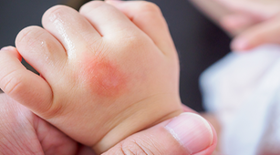 10 Tanda Dermatitis Atopik pada Anak dan Orang Dewasa